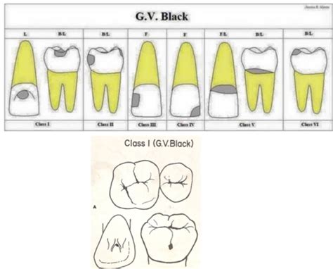 Caries Classification Ii Flashcards Quizlet