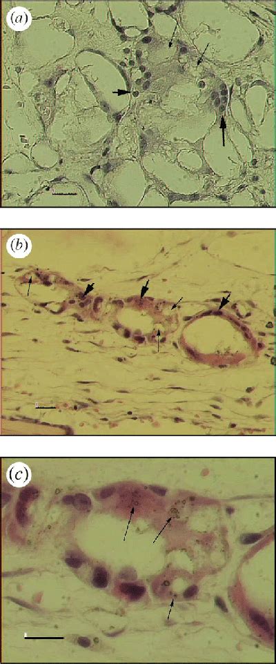 Macrophages And Multinuclear Cells Associated With The Particles A