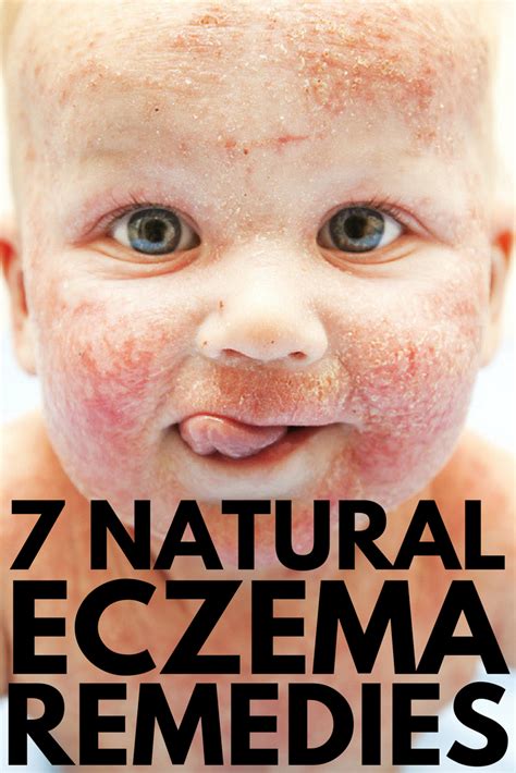 Eczema Treatment