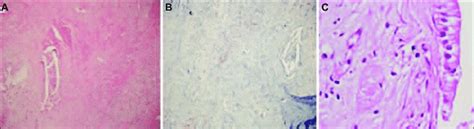 A Mononuclear Inflammatory Cells In The Hypocelluler Fibrotic