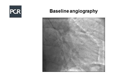 Complex Pci In High Bleeding Risk Patients