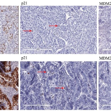 Different Pattern Of Nuclear Immunohistochemical Expression Of P53 P21 Download Scientific