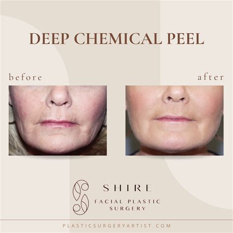 Deep Chemical Peels Before And After Shire Facial Plastic Surgery