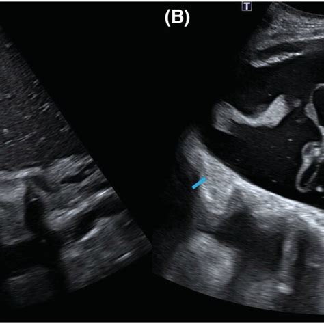 Ultrasound Right A And Left B Thorax And Pleural Cavity Showing Download Scientific Diagram