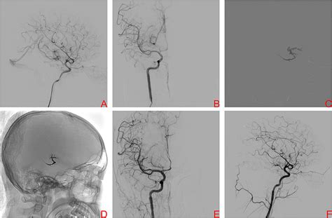 Frontiers Transvenous Embolization Of Hemorrhagic Brain Arteriovenous Malformations Case