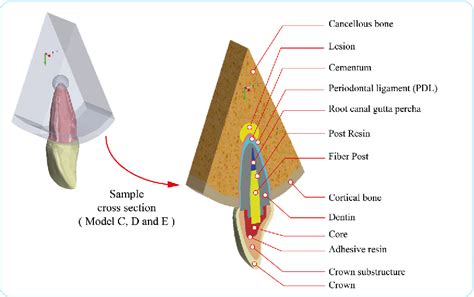 Figure 1 From Evaluation Of Stress Distribution On An Endodontically Treated Maxillary Central