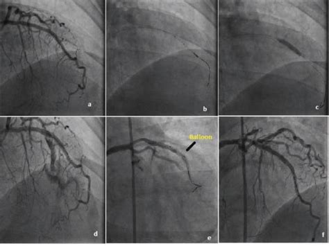 ivus guided optimization of mid lad stent produced type iii cap a