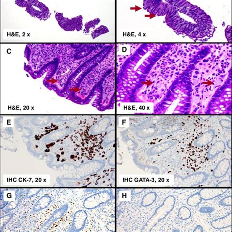 Unremarkable Colonic Mucosa Seen During Colonic Endoscopy A And B Download Scientific