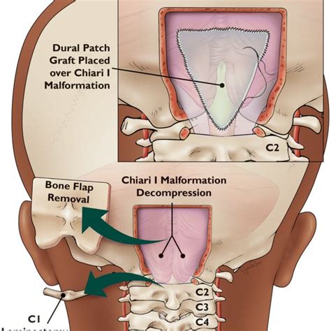Comparison Of Surgical Outcomes In Patients With Chiari Type I Malformation Receiving Posterior