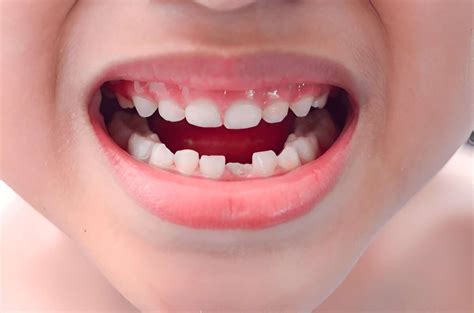 Wisdom Teeth After Braces Should You Be Worried Infinite Orthodontics