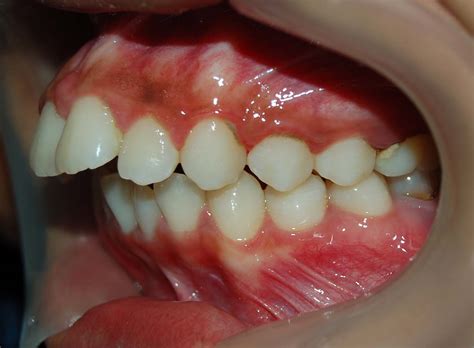 Aryabrahmanta Evaluation Of Class Ii Div 1 Malocclusion Using Icon And