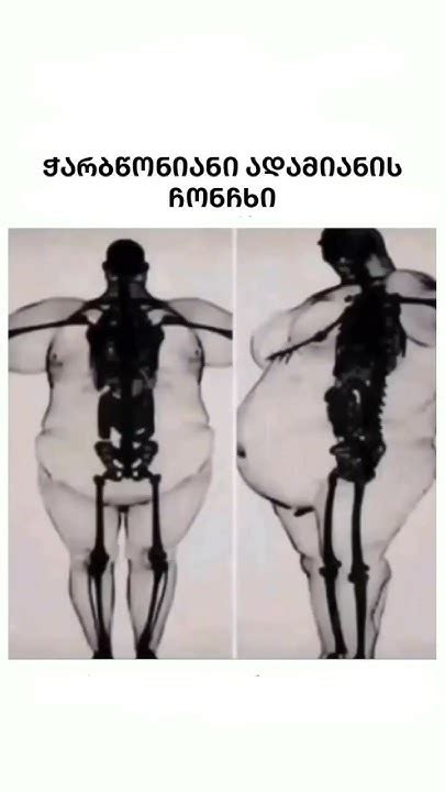 [ჭარბწონიანი ადამიანის ჩონჩხი] გამოიწერე ჩემი გვერდი Youtube