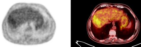 Can Y 90 Radioembolization Be Done In Hcc With High Flow A P Shunting