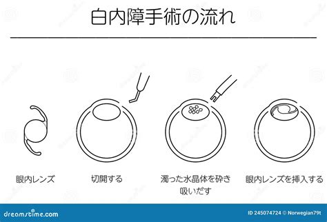 Intraocular Lens Structure Diagram Medical Science Cartoon Vector