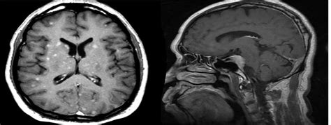 Identification Of Brain Tumors Using Svm Classifier