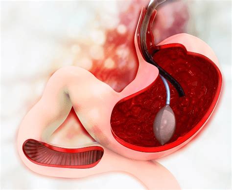 Exploring Ercp A Comprehensive Guide