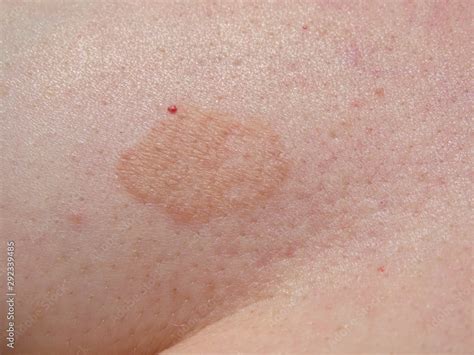Patch Dermatology