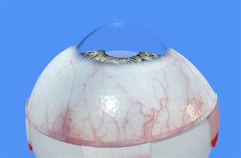 Een Gids Voor Oorzaken En Behandeling Van Cornea Neovascularisatie Bril Op Je Hoofd