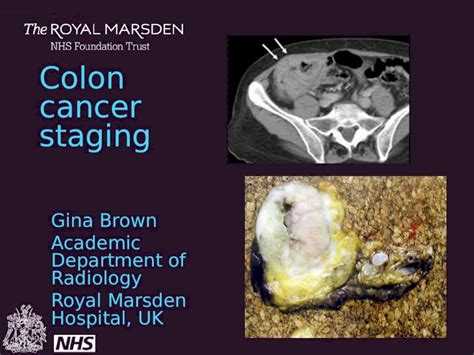 Ppt Ct Colon Staging And Importance Of Proforma Reporting Dokumen Tips