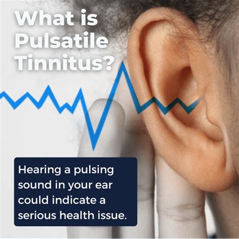 Rebecca Lewis On Linkedin What Is Pulsatile Tinnitus