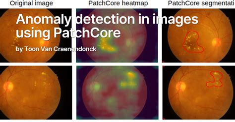 anomaly detection in images using patchcore
