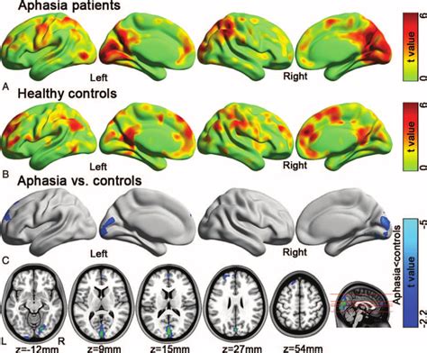 Comparison Of Intrinsic Local Synchronization Patterns Between Groups