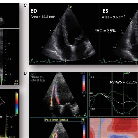 Determination Of Right Ventricular RV Systolic Function In A Typical Download Scientific