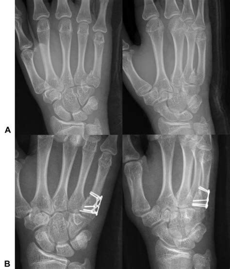 Surgical Outcomes Of Percutaneous Pinning And Open Locking Plating In Patients With Intra