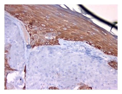 A Subcutaneous Mass On The Vertex Of The Scalp With Ulcerated