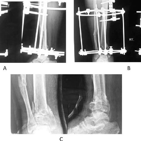 Pdf Open Reduction Internal Fixation Versus External Fixation