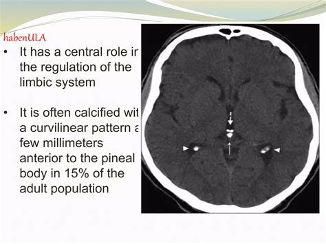 Physiological And Pathological Calcification Of Brain Pptx
