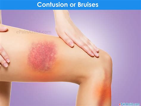 Muscle Contusion Bruise