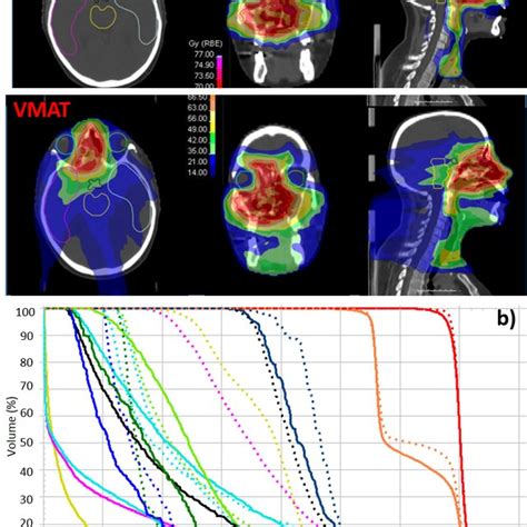 A Representative Example Of Dose Distribution For Impt And Vmat