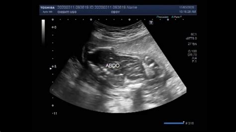 Ultrasound Video Showing Pregnancy With Fetal Demise And Positive