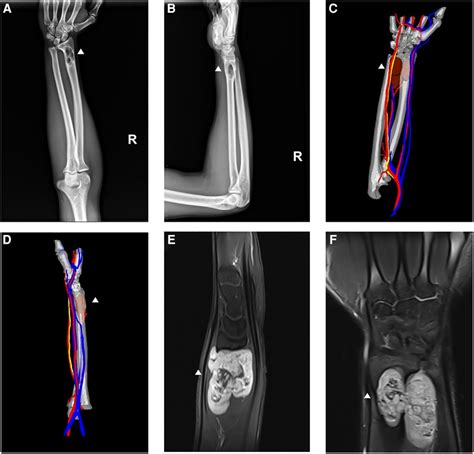 Frontiers Successful Management Of A Rare Radius Schwannoma Mimicking Malignant Bone Tumors A