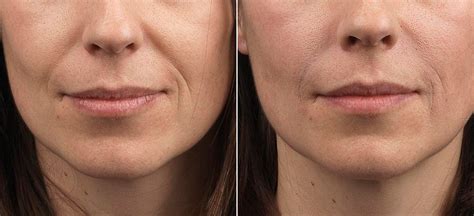 ეს ნიღაბი სტიმულირებს კოლაგენის გამომუშავებას და ამცირებს ყველაზე ღრმა ნაოჭებსაც კი