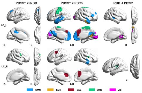 Disruption Of Locus Coeruleus Related Functional Networks In Parkinsons Disease Mds Abstracts