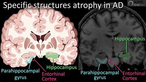 Parahippocampal Gyrus Base Of The Brain 🧠 Basal Aspect Of The