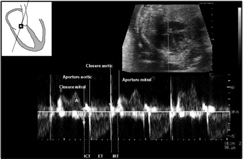 measurement of the left mod mpi above location of the sample volume on
