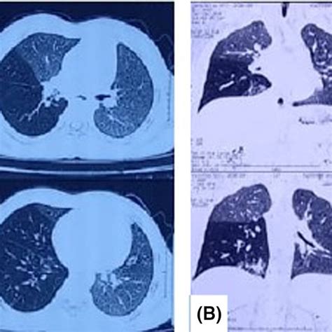 Soft Tissue Growth At Bronchus Intermedius Download Scientific Diagram