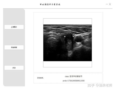 深度学习之基于resnet50卷积神经网络甲状腺结节分类识别系统 知乎