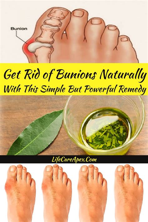 Get Rid Of Bunions Naturally With This Simple But Powerful Remedy Get Rid Of Bunions Bunion