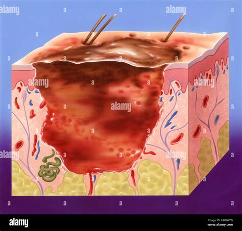 Third Degree Burn Cut Away Artwork A Third Degree Burn Is A Severe