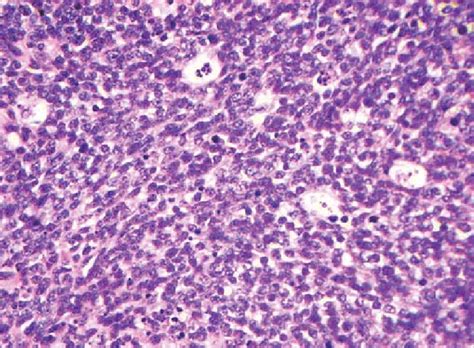 Predominant Sheets Of Round Cells Having Hyperchromatic Nuclei Download Scientific Diagram