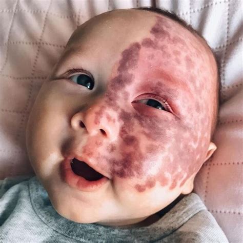 Radio Show Slammed Over Offensive Birthmark Segment The Courier Mail