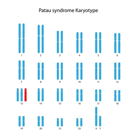 Trisomy 13 Syndrome
