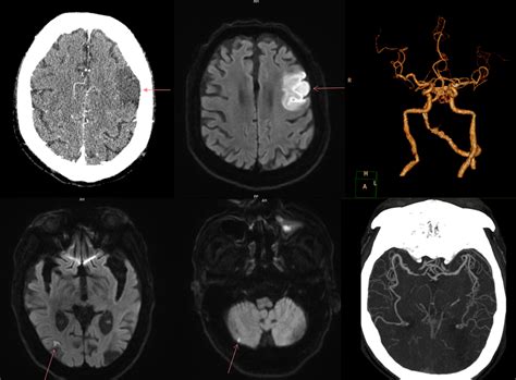 Concurrent Acute Ischemic Stroke And Myocardial Infarction Associated