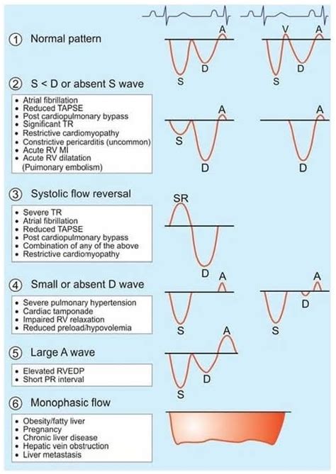 The Heart 🔴 Hepatic Vein Waveform Alterations In Various Scenarios
