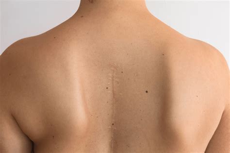 Surgical Treatment For Scoliosis