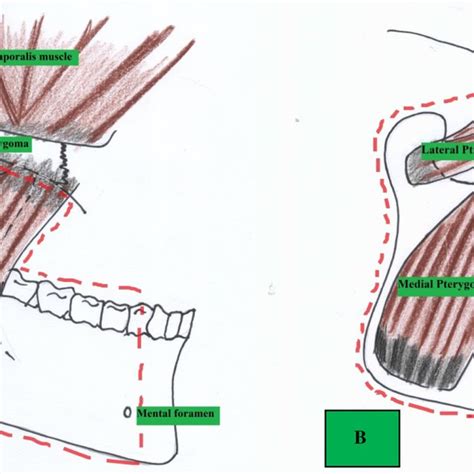 Composite Resection With Itf Compartment Resection Done Download Scientific Diagram